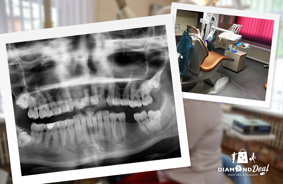 Panoráma röntgen készítése konzultációval