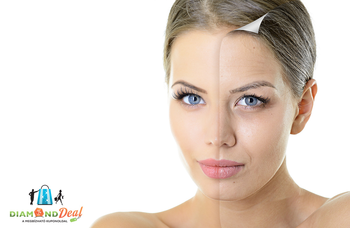 Ultima Hifu teljes szájkörnyék, mosolyránc kezelés